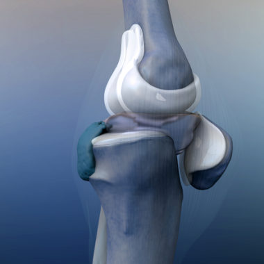 Innenmeniskusriss - Ursachen und Therapie (Riss des Innenmeniskus)