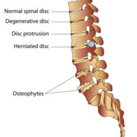 Protrusion Bandscheibe - Therapie für HWS, BWS, LWS