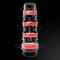 Diskopathie - Ursachen, Symptome, Therapie