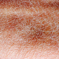 Erythrasma – Symptome, Therapie und Behandlung